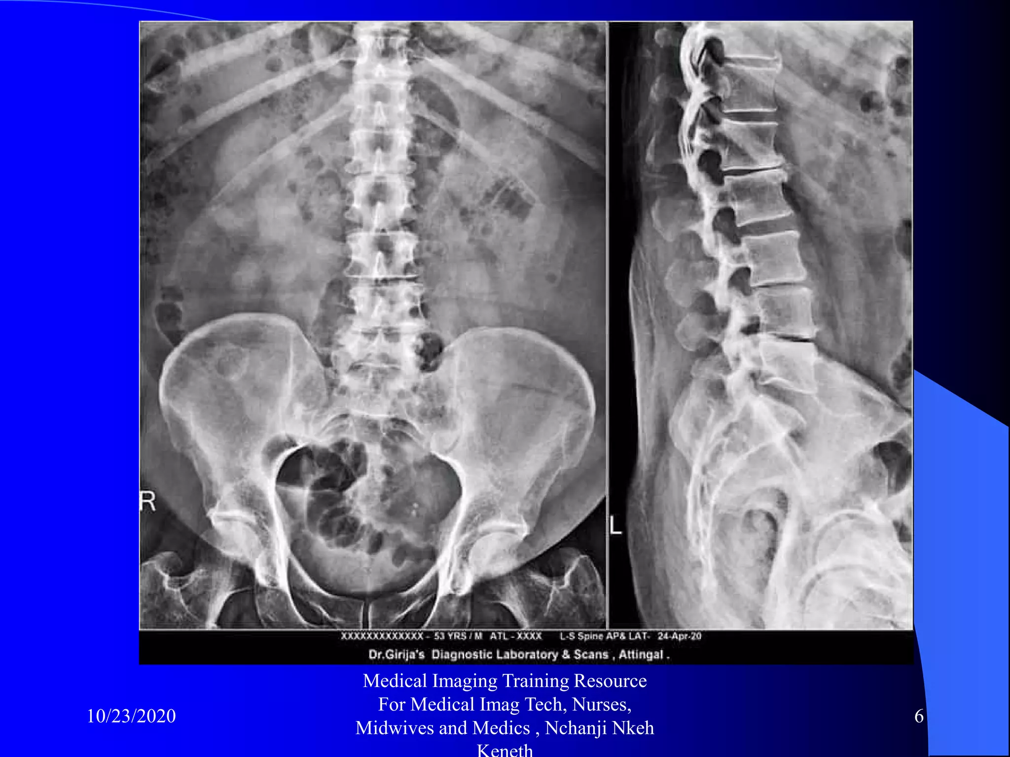 Dorso lumbar spine x-ray radiology training resource nchanji nkeh ...