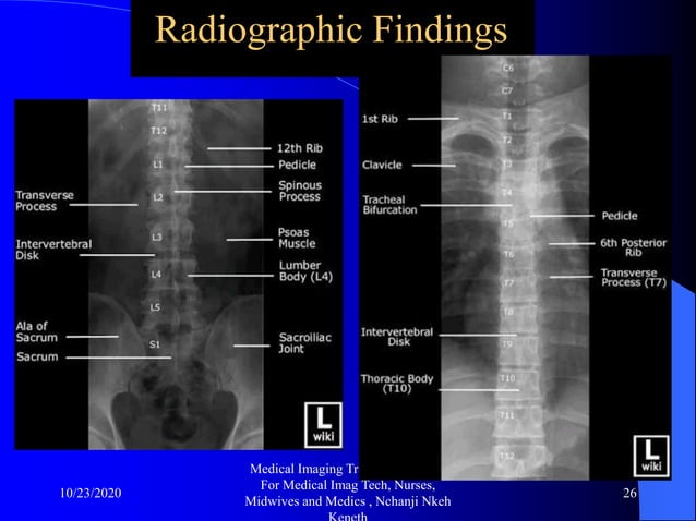 Dorso lumbar spine x-ray radiology training resource nchanji nkeh ...