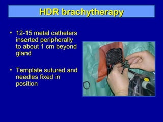 Dose Response In Prostate Cancer | PPT