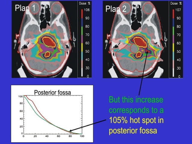 Dose volume histogram | PPT | 3-D Graphics | Computer Software and Applications