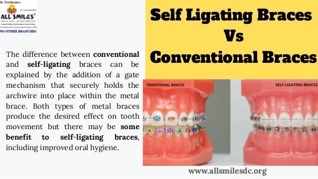 Do Self Ligating Braces Works Better Than Regular Conventional Braces