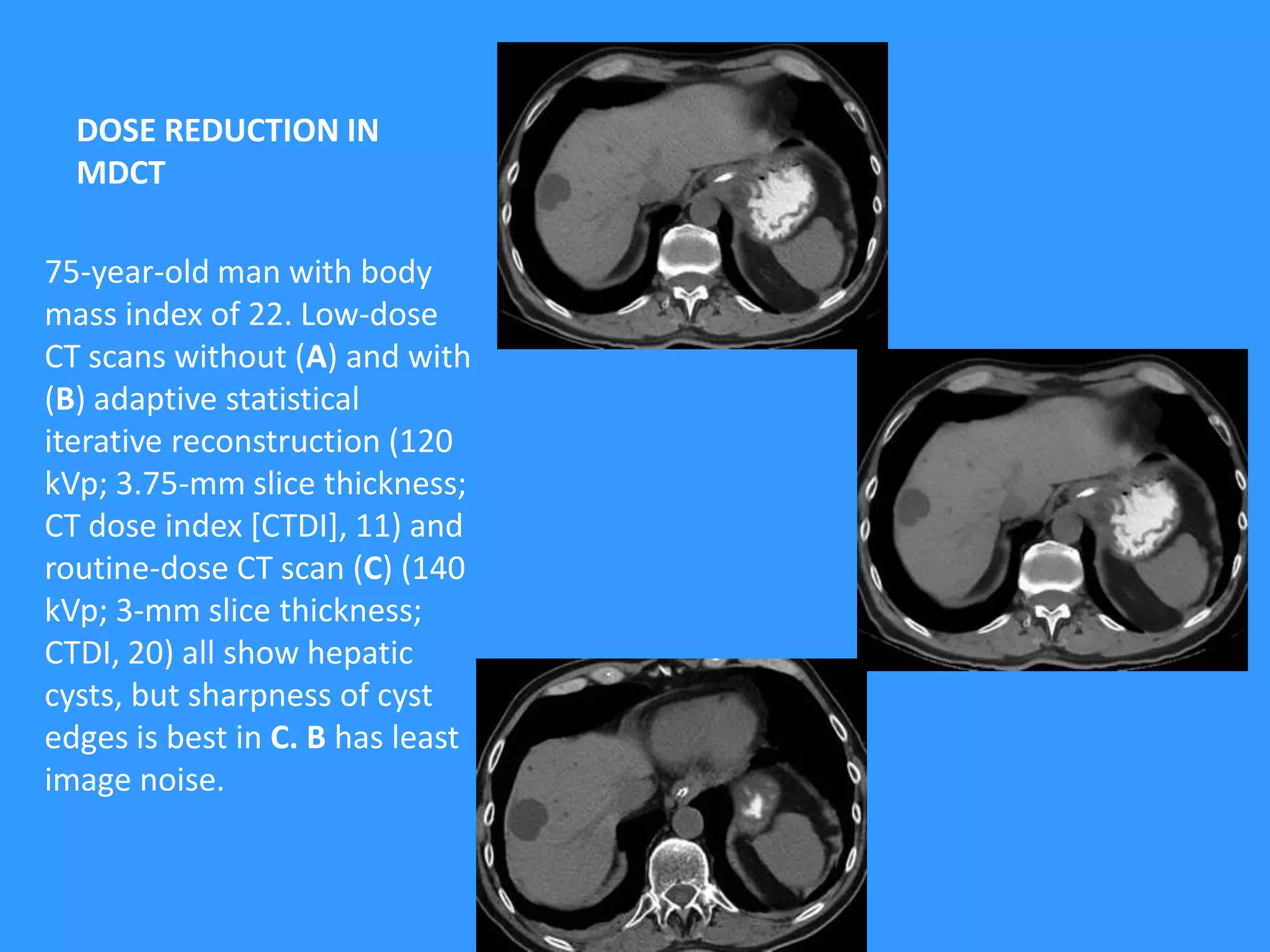 Dose reduction in MDCT . Daniel J.P , Khorfakhan hospital . UAE | PPT