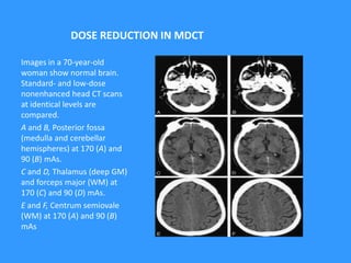 Dose reduction in MDCT . Daniel J.P , Khorfakhan hospital . UAE | PPT