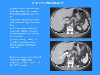 Dose reduction in MDCT . Daniel J.P , Khorfakhan hospital . UAE | PPTX