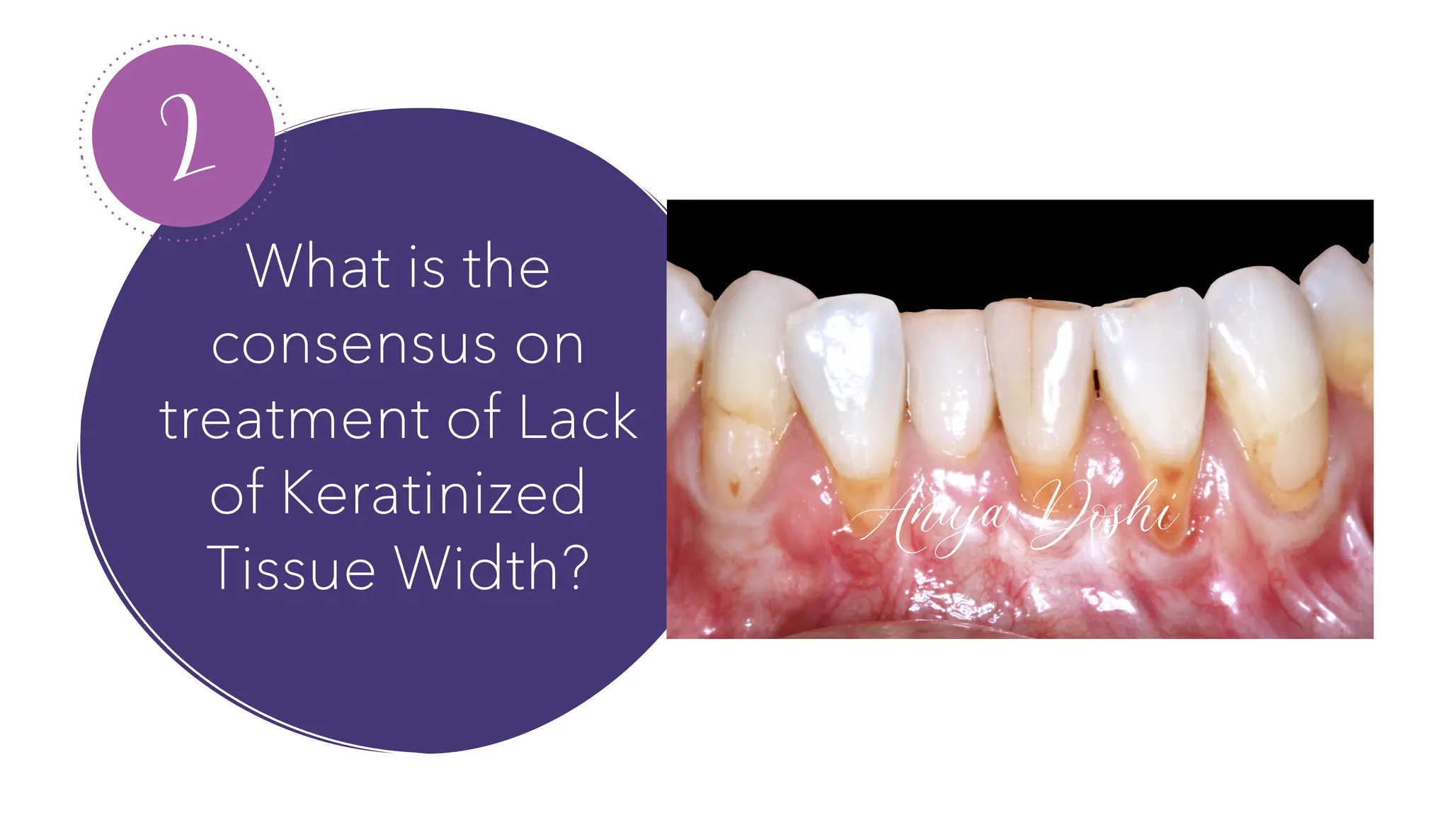 Periodontal/Peri-implant Soft tissue phenotype | PDF