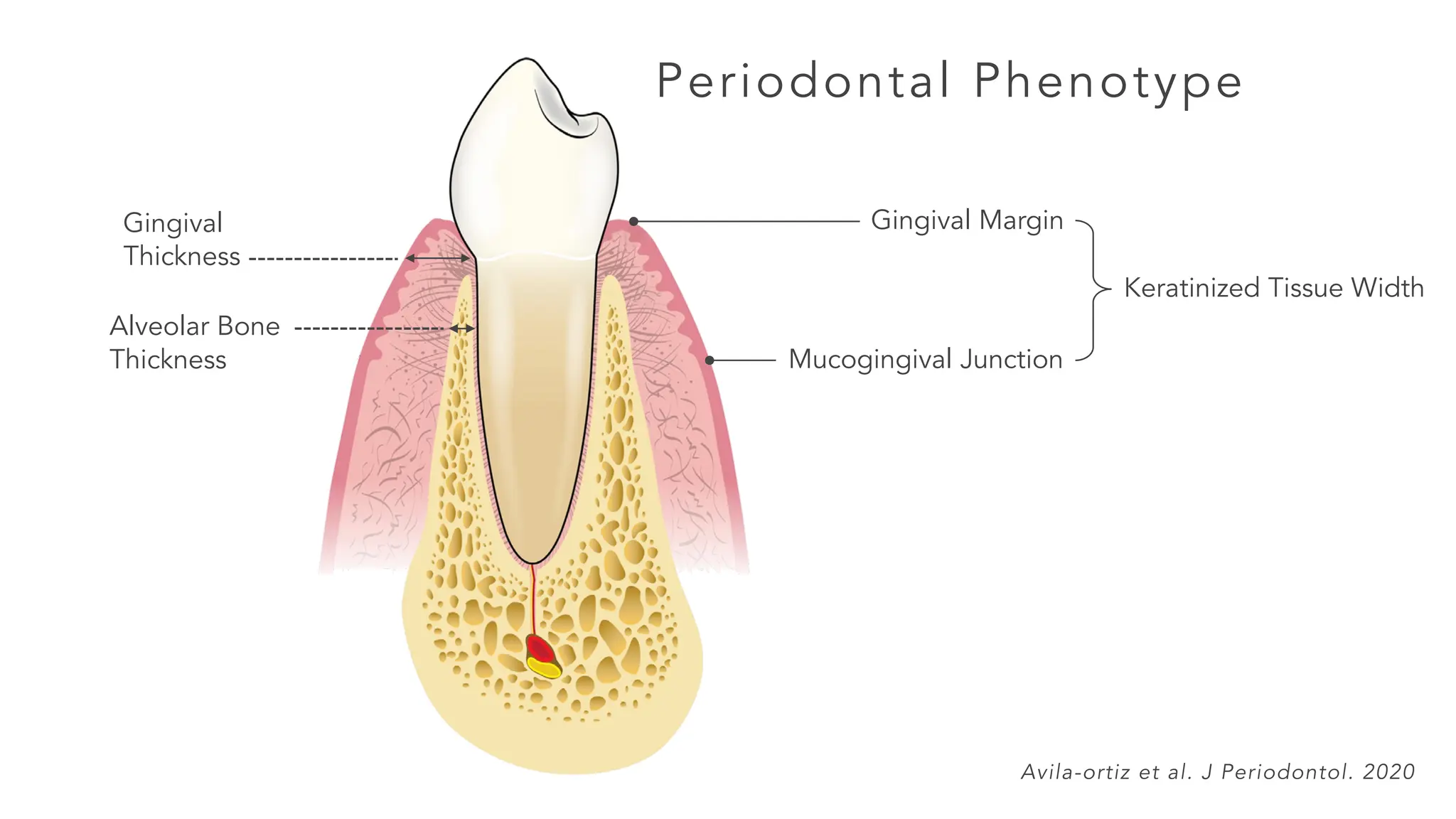 Periodontal/Peri-implant Soft tissue phenotype | PDF