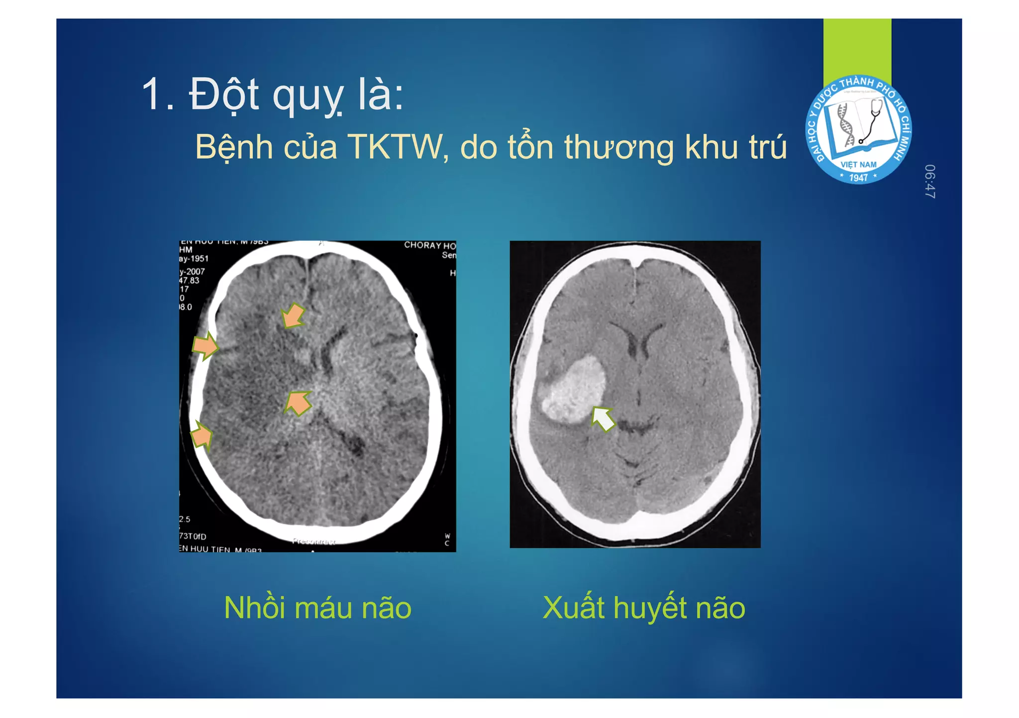 Đột quỵ - Đại học Y dược TPHCM | PDF