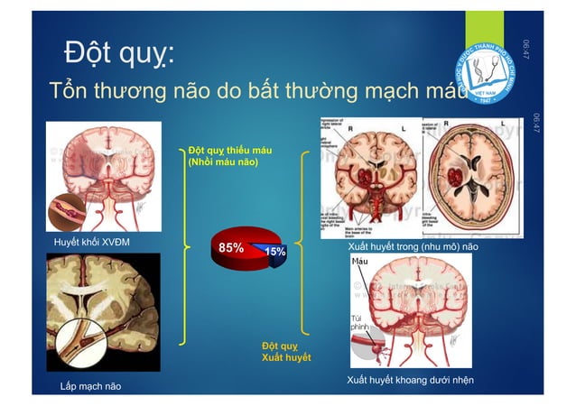 Đột quỵ - Đại học Y dược TPHCM | PDF