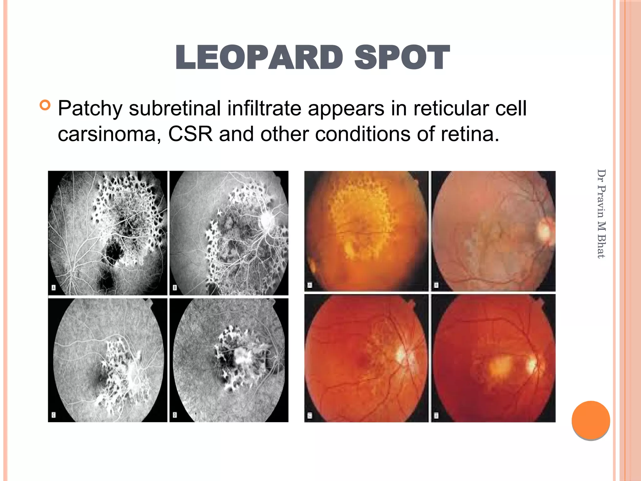 Dots spots lines_and_rings_in_ophthalmology | PDF | Eye and Vision ...