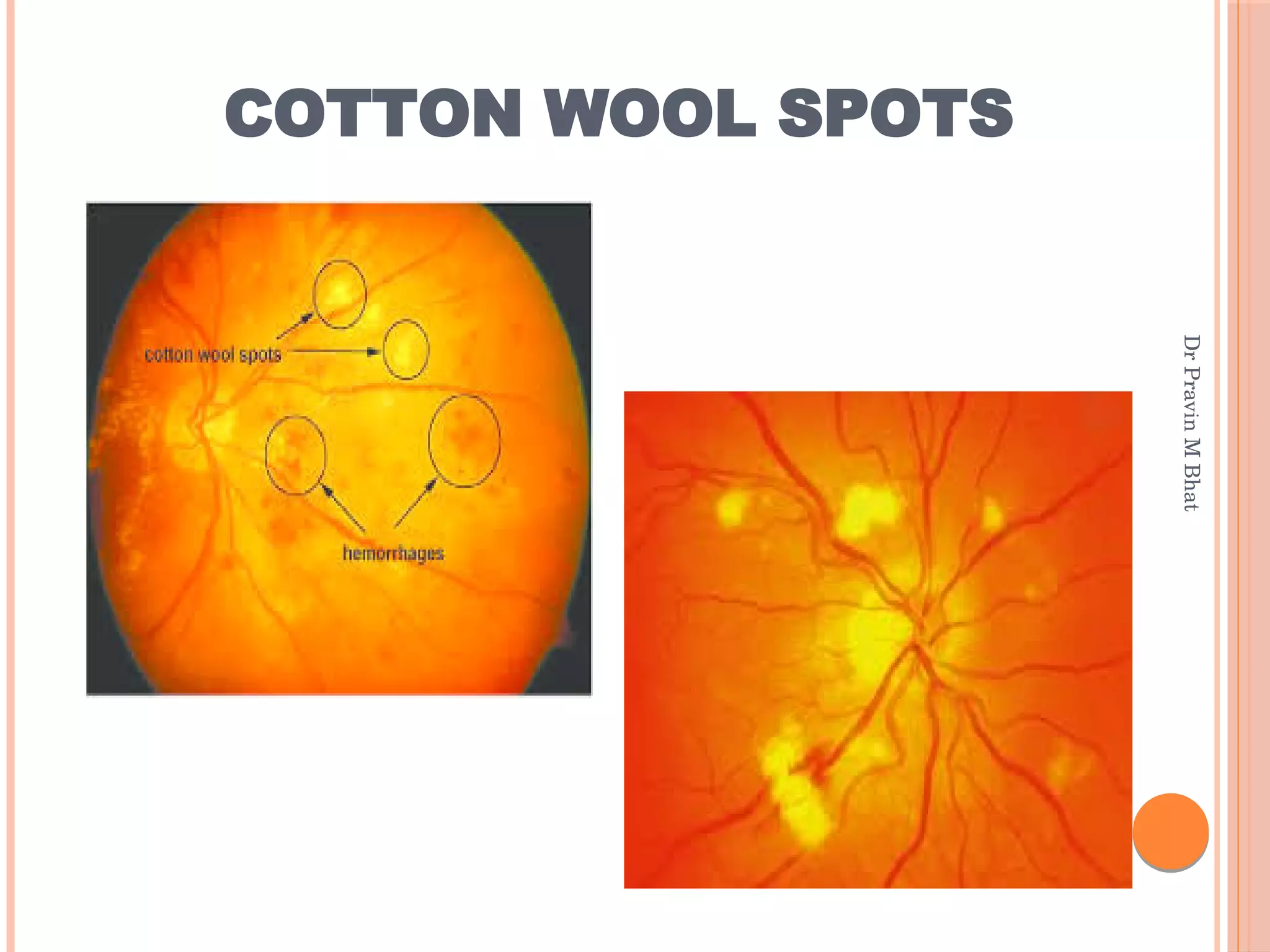 Dots spots lines_and_rings_in_ophthalmology | PDF | Eye and Vision ...