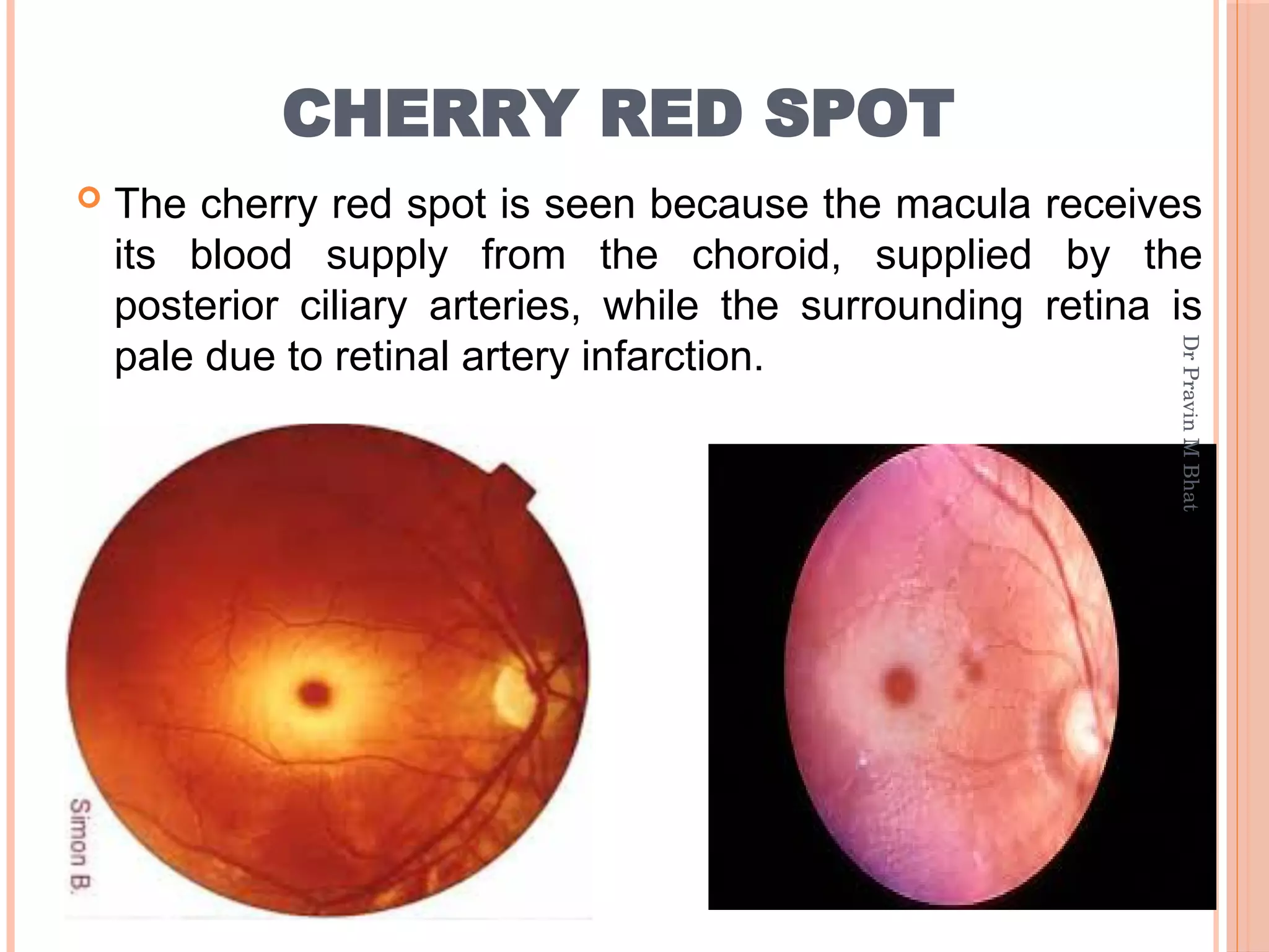 Dots spots lines_and_rings_in_ophthalmology | PDF | Eye and Vision ...