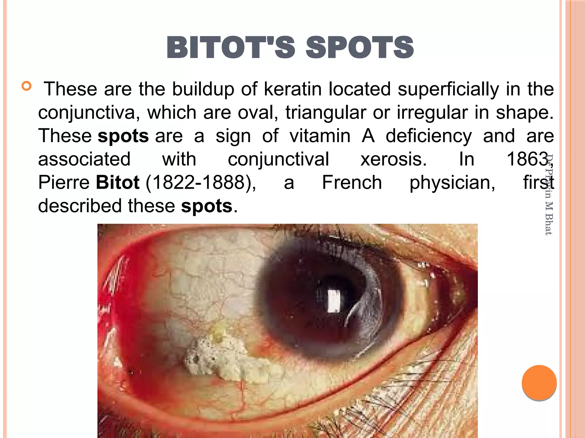 Dots spots lines_and_rings_in_ophthalmology | PDF | Eye and Vision ...
