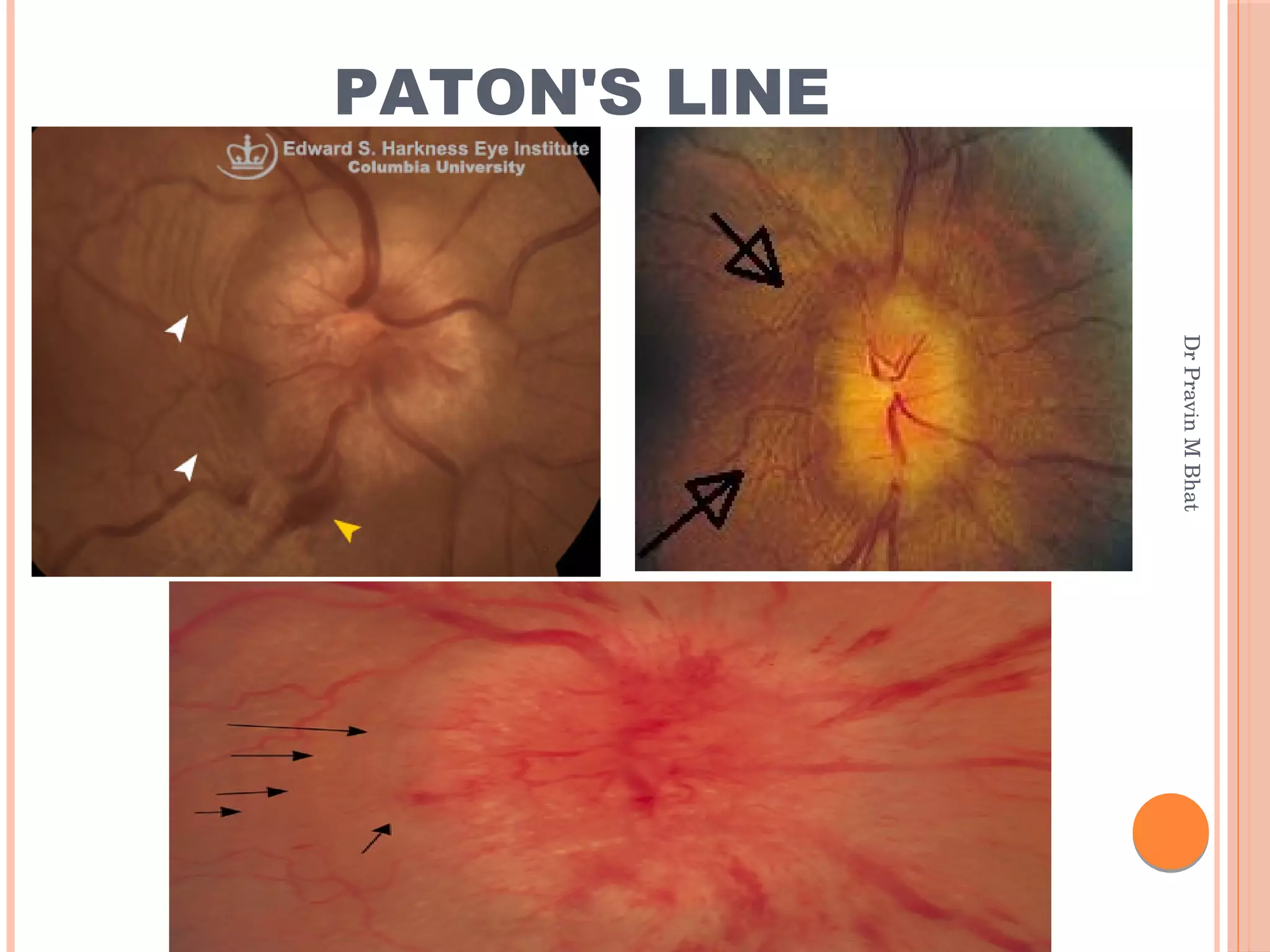 Dots spots lines_and_rings_in_ophthalmology | PDF | Eye and Vision ...
