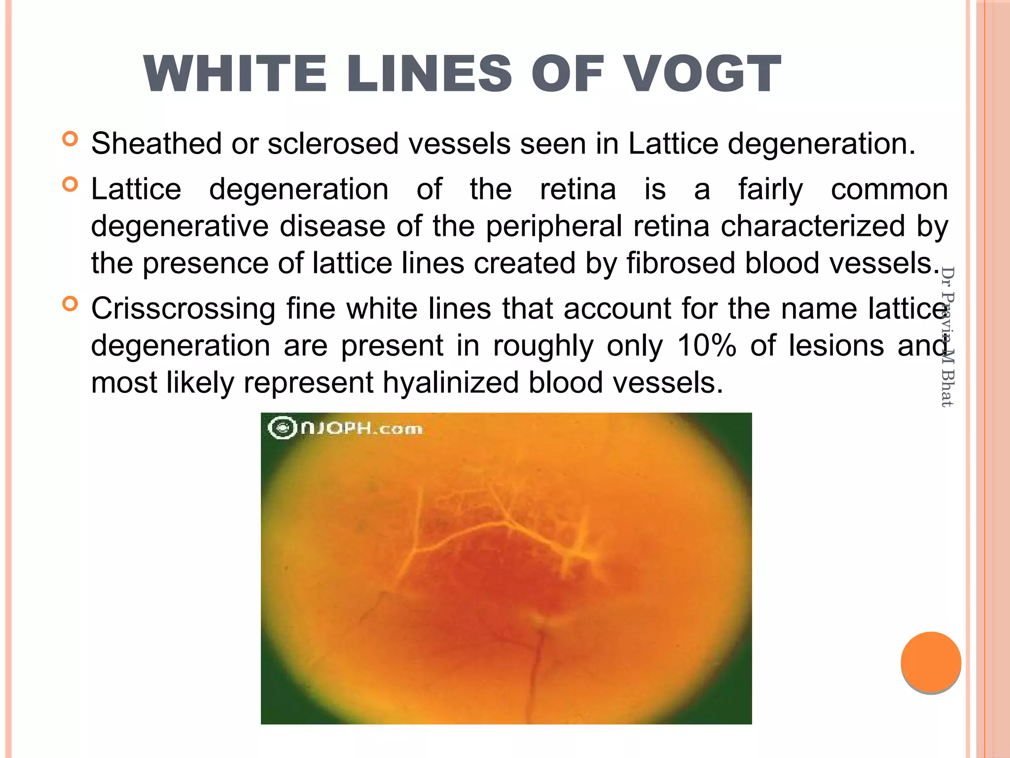 Dots spots lines_and_rings_in_ophthalmology | PDF | Eye and Vision ...