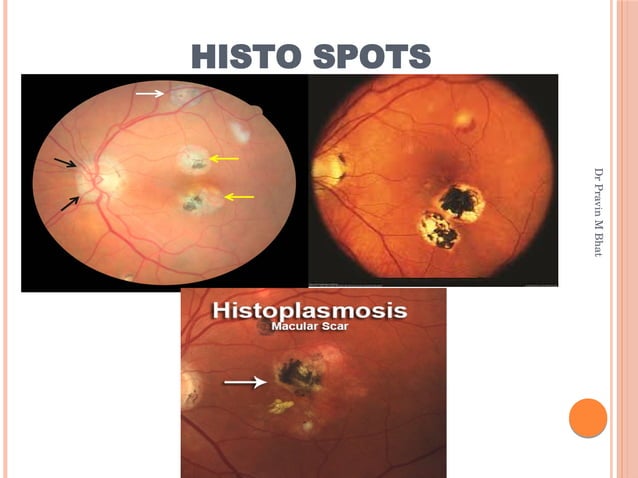 Dots spots lines_and_rings_in_ophthalmology | PDF | Eye and Vision ...