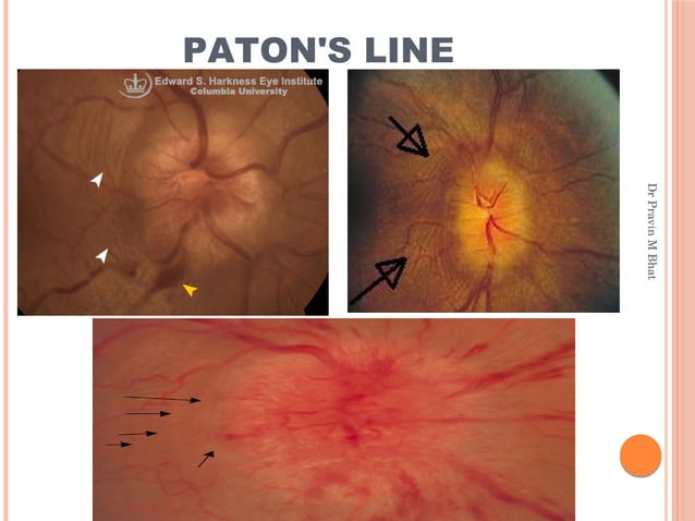 Dots spots lines_and_rings_in_ophthalmology | PDF | Eye and Vision ...