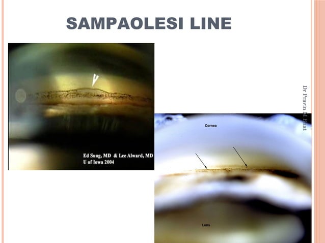 Dots spots lines_and_rings_in_ophthalmology | PDF | Eye and Vision ...