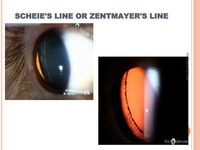 Dots spots lines_and_rings_in_ophthalmology | PDF | Eye and Vision ...