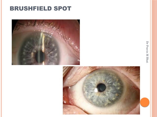 Dots spots lines_and_rings_in_ophthalmology | PDF | Eye and Vision ...