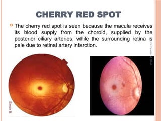 Cherry Red Spot