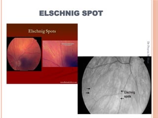 Elschnig Spots