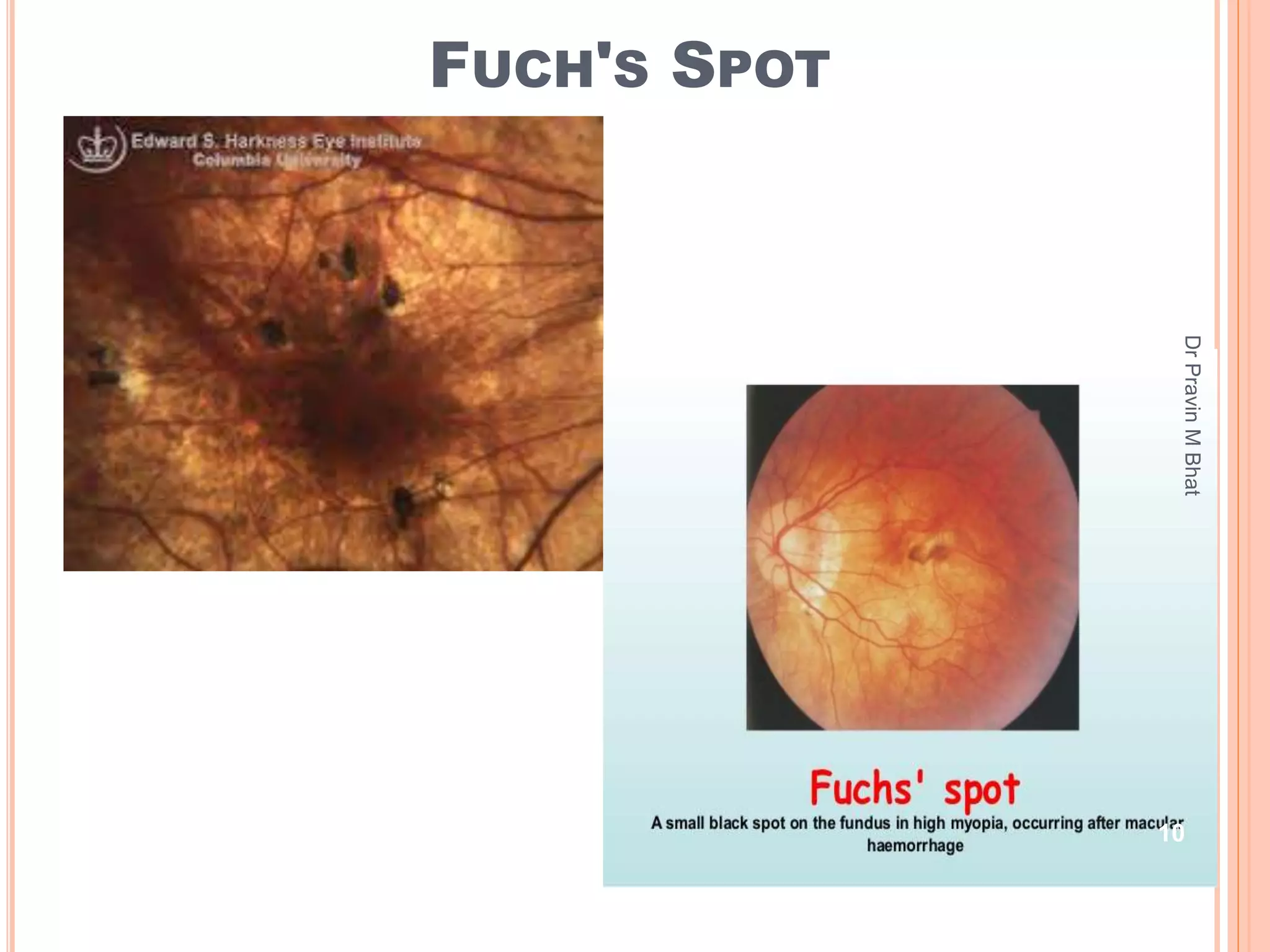 Dots spots lines and rings in ophthalmology | PPTX