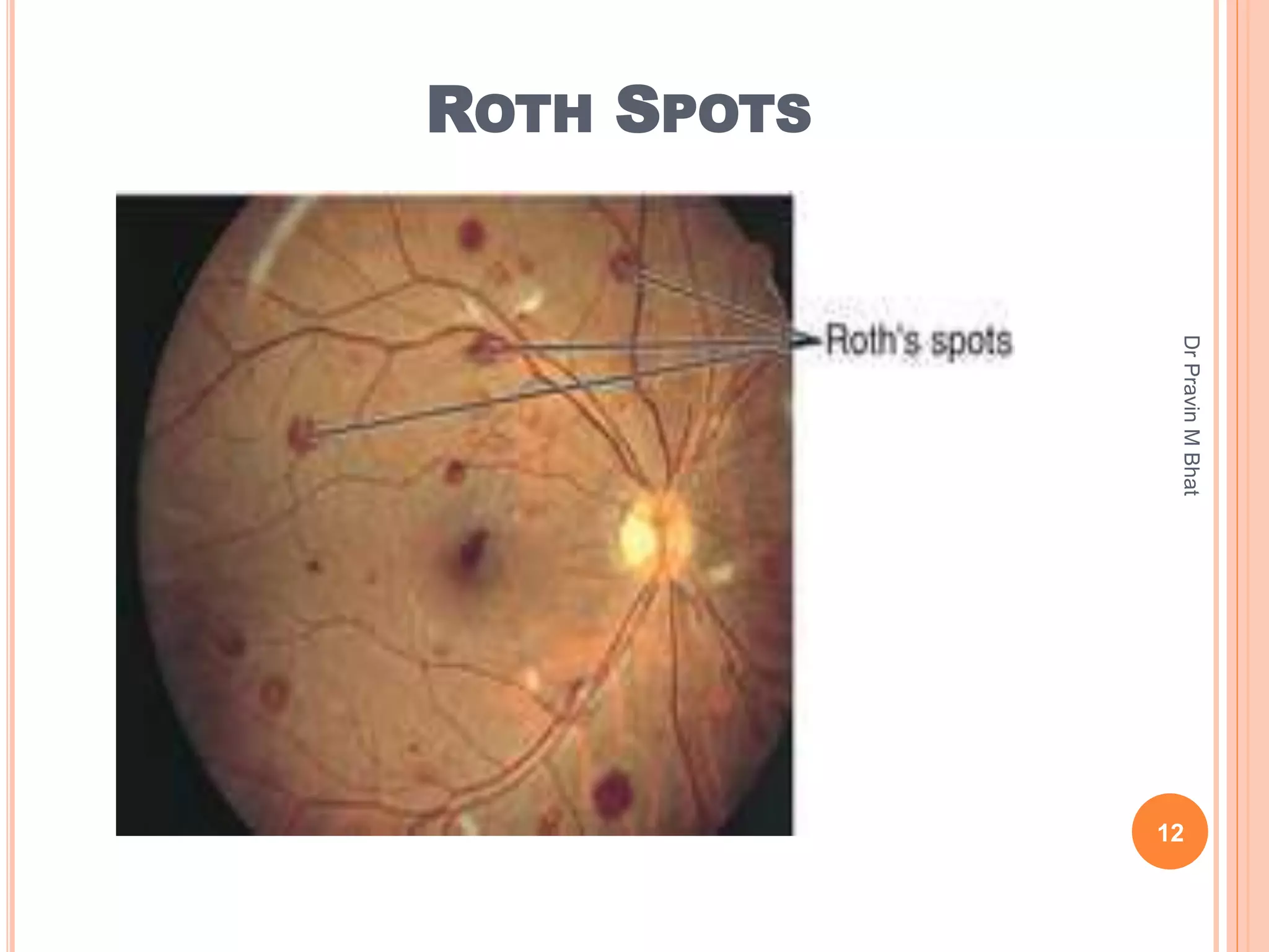 Dots spots lines and rings in ophthalmology | PPTX