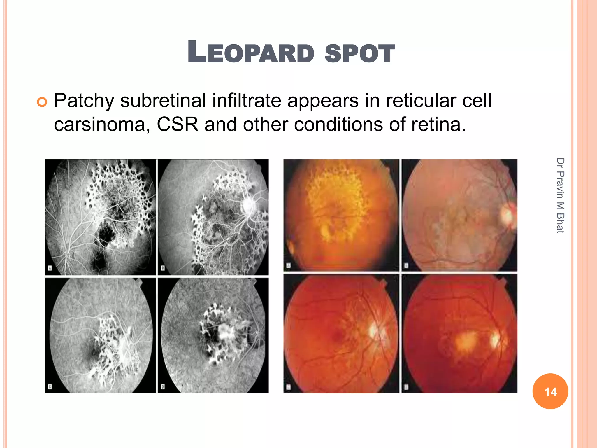 Dots spots lines and rings in ophthalmology | PPTX