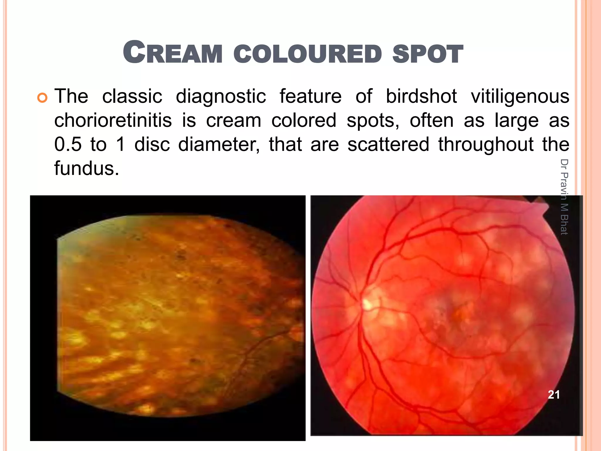 Dots spots lines and rings in ophthalmology | PPTX