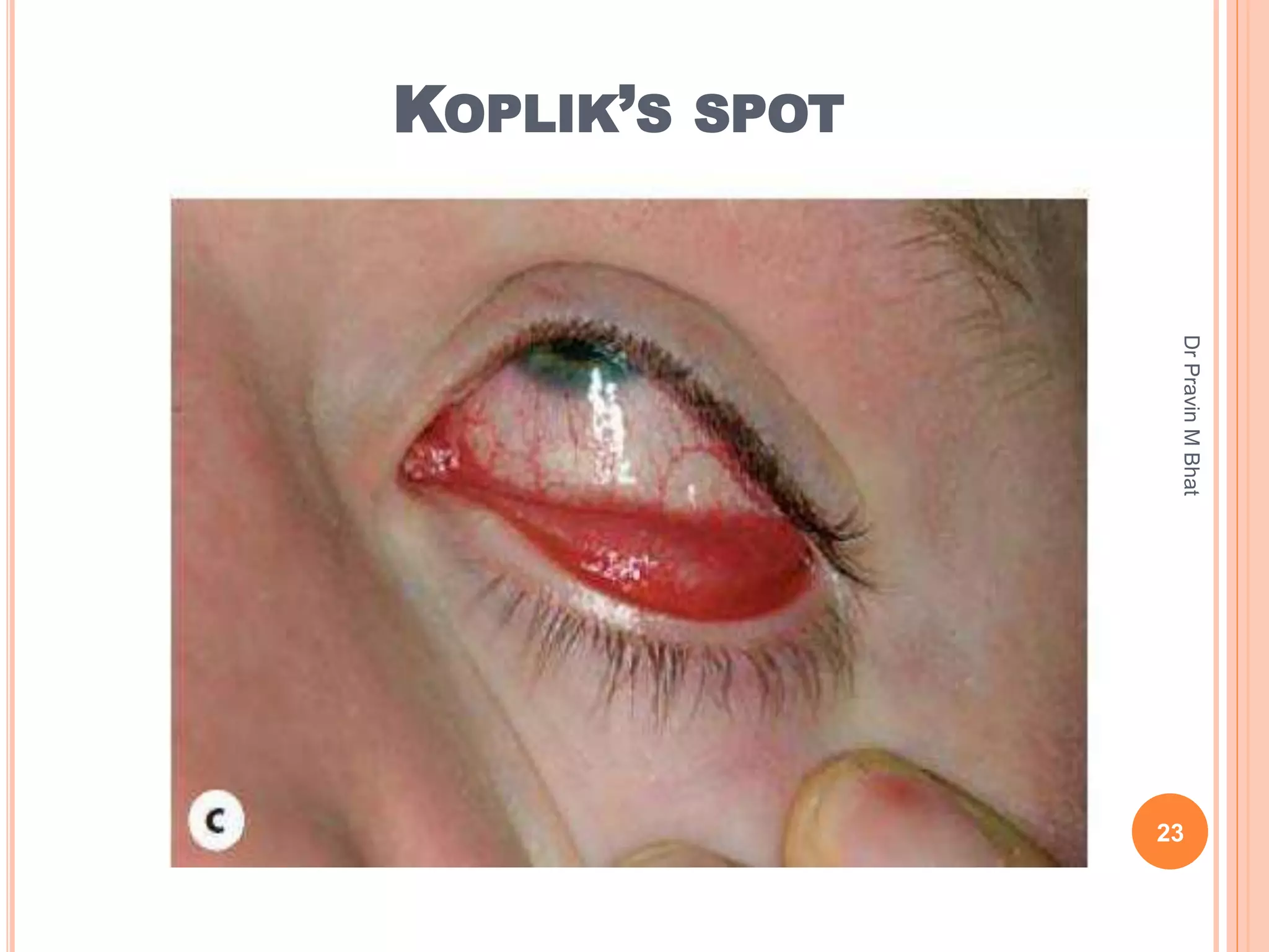 Dots spots lines and rings in ophthalmology | PPTX