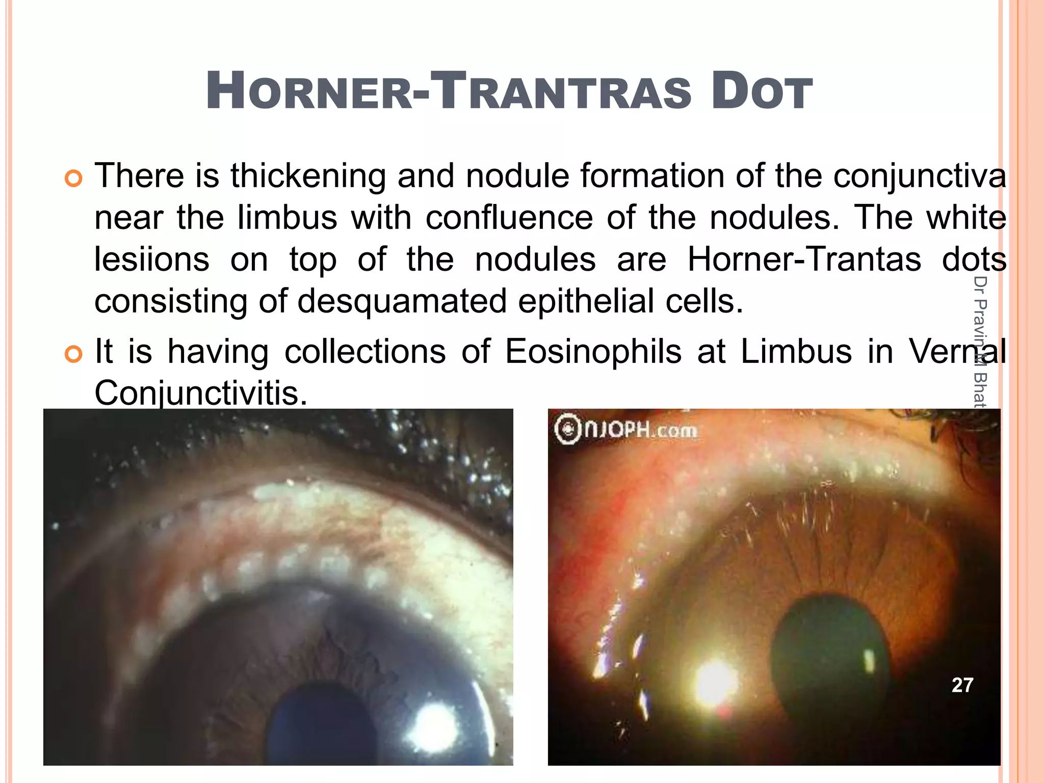 Dots spots lines and rings in ophthalmology | PPTX