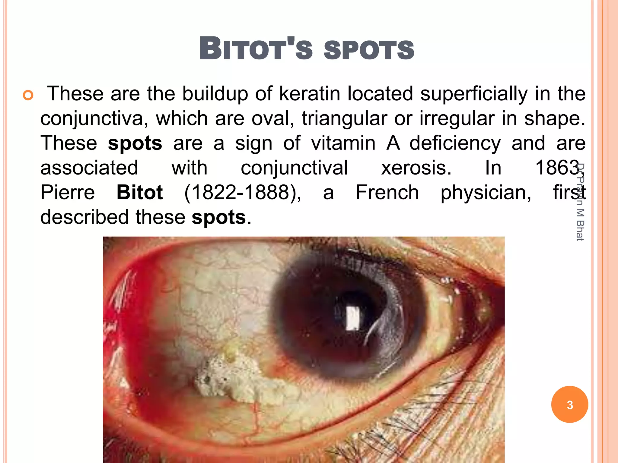 Dots spots lines and rings in ophthalmology | PPTX