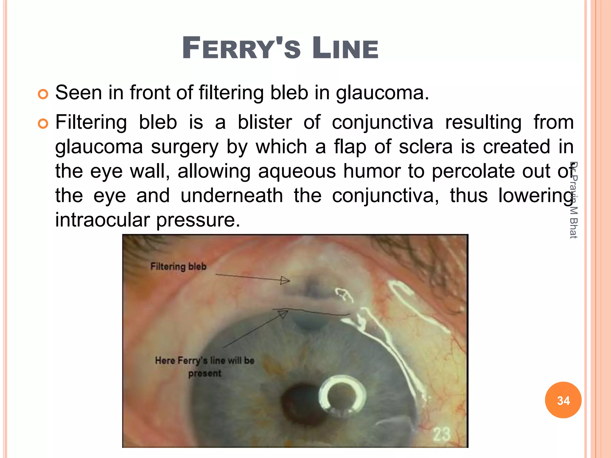 Dots spots lines and rings in ophthalmology | PPTX