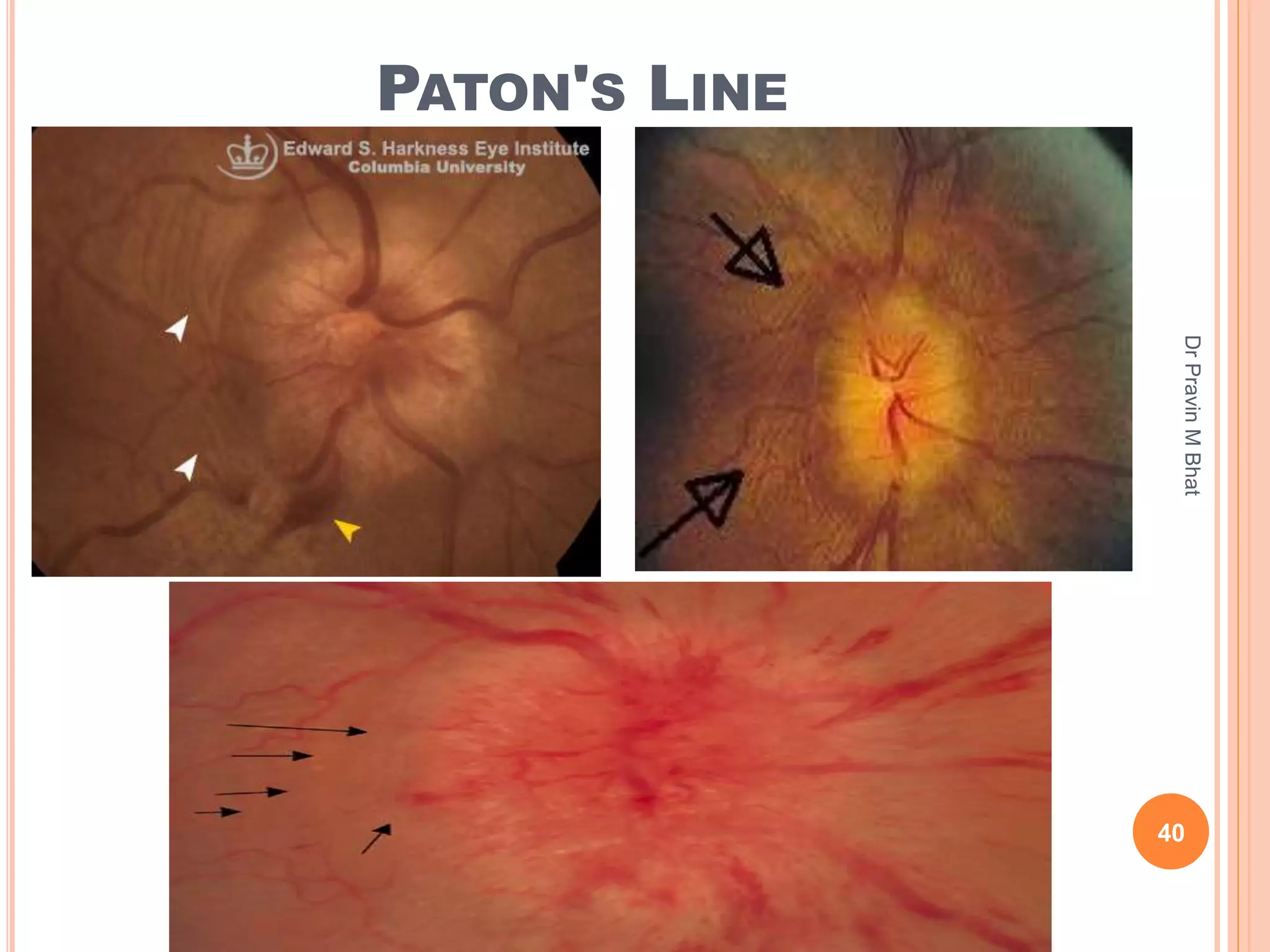 Dots spots lines and rings in ophthalmology | PPTX