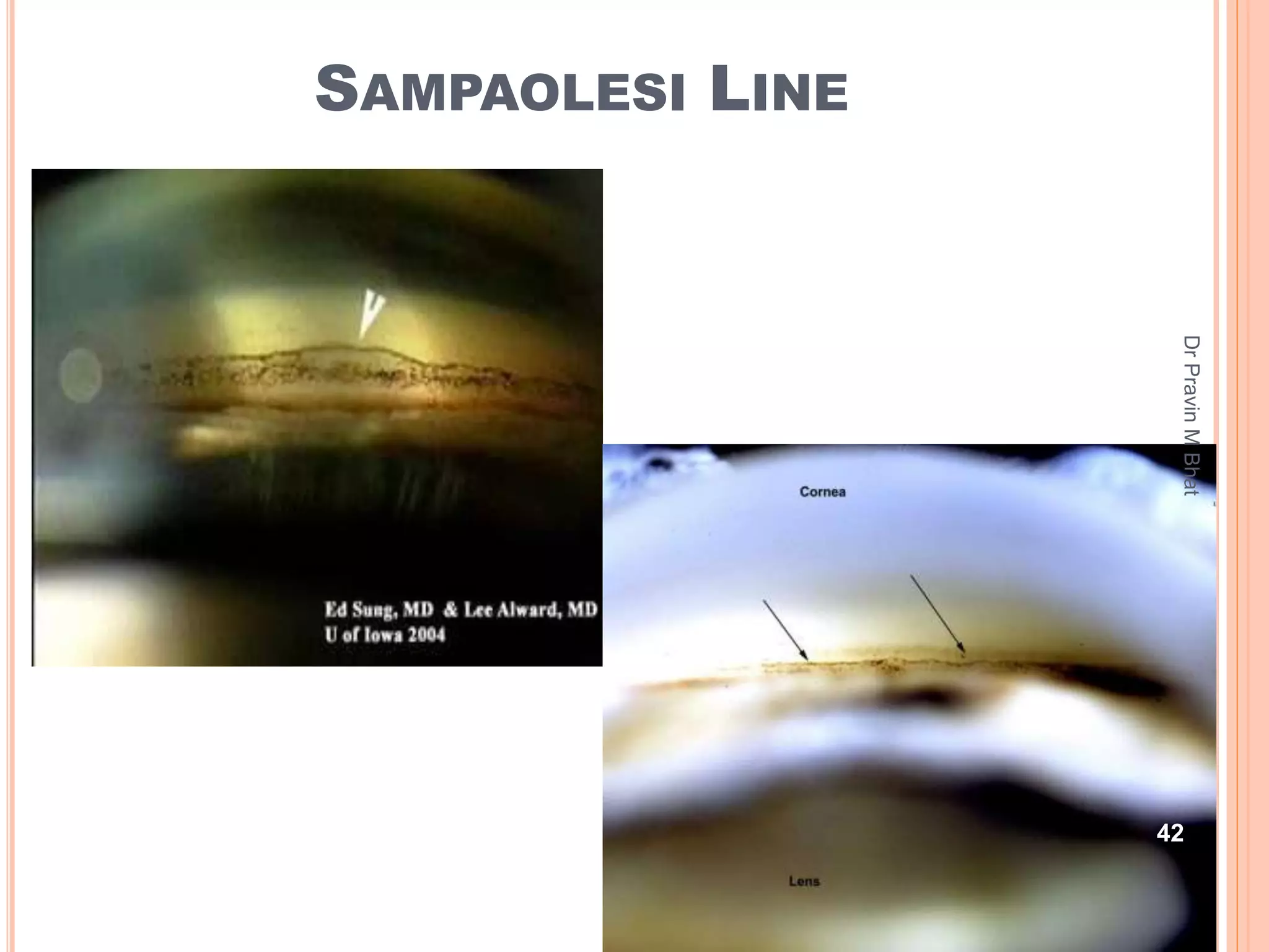 Dots spots lines and rings in ophthalmology | PPTX