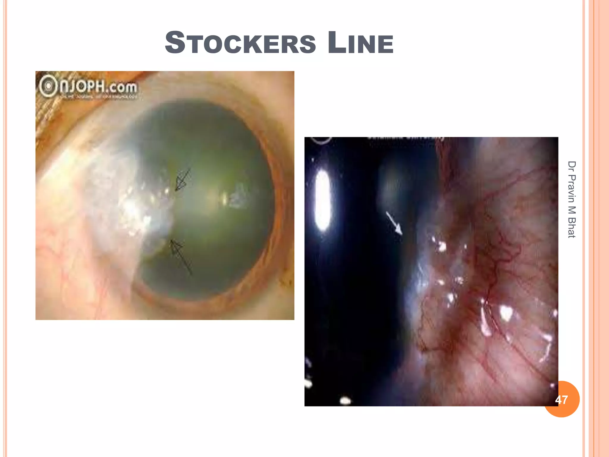Dots spots lines and rings in ophthalmology | PPTX