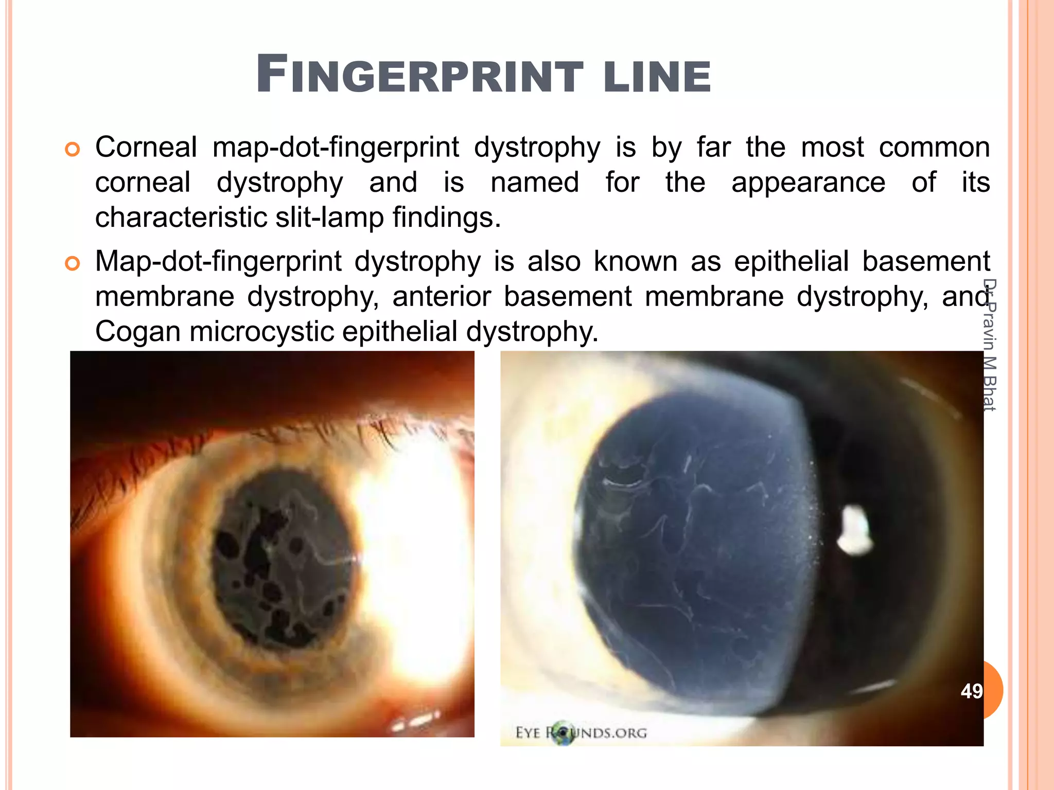 Dots spots lines and rings in ophthalmology | PPTX