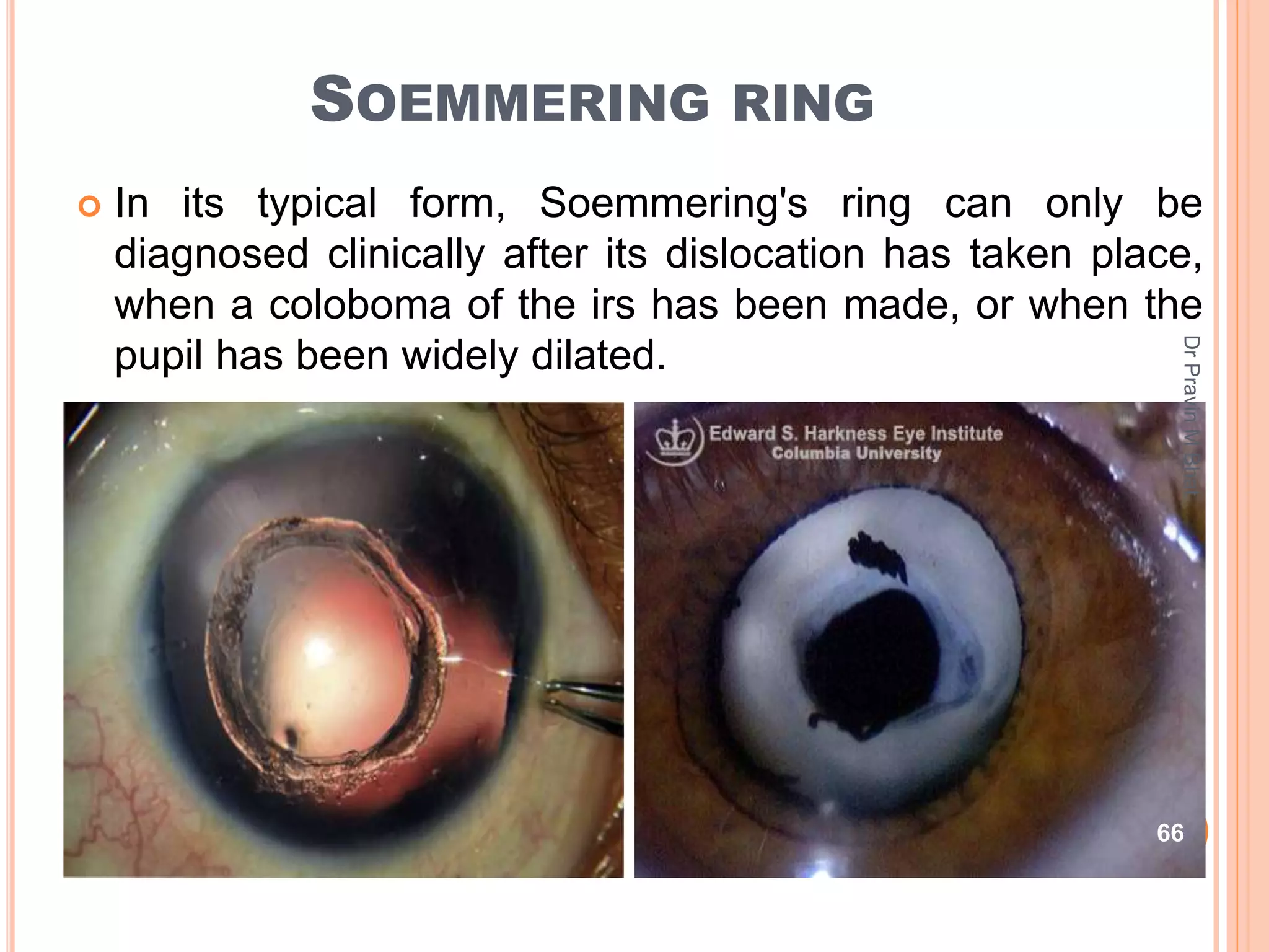 Dots spots lines and rings in ophthalmology | PPTX