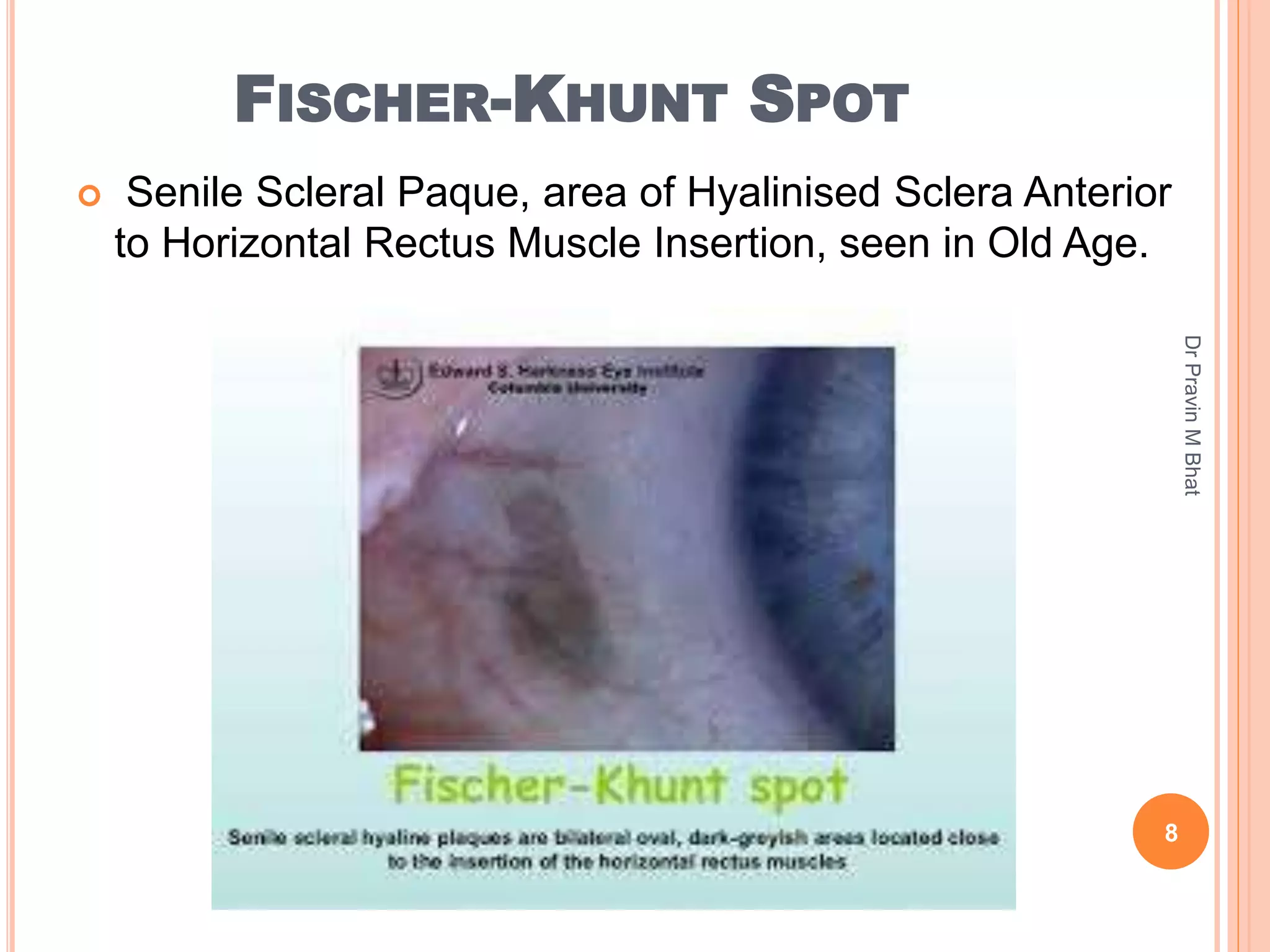 Dots spots lines and rings in ophthalmology | PPTX