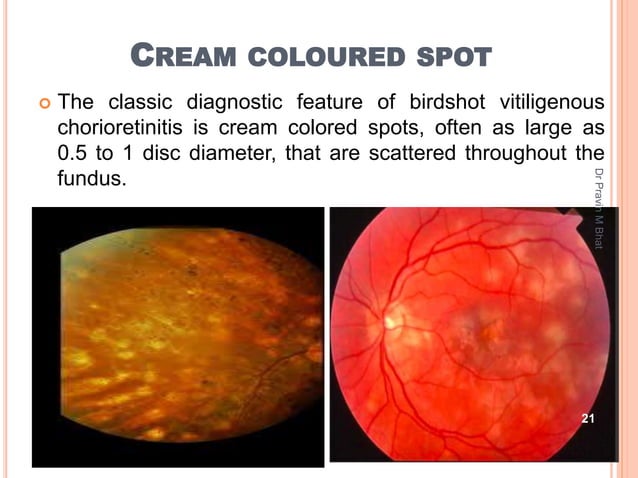Dots spots lines and rings in ophthalmology | PPTX | Eye and Vision ...