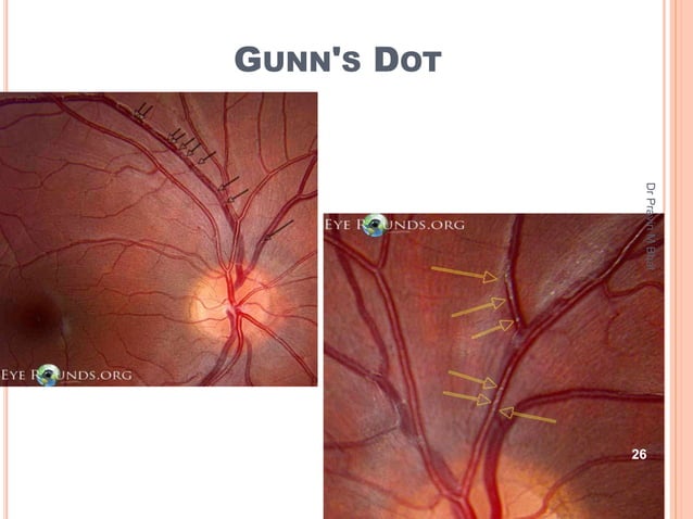 Dots spots lines and rings in ophthalmology | PPTX | Eye and Vision ...