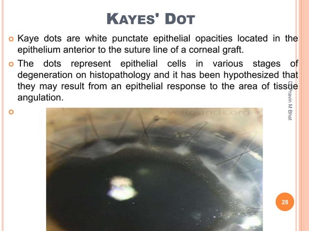 Dots spots lines and rings in ophthalmology | PPTX | Eye and Vision ...