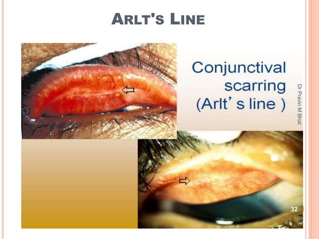 Dots spots lines and rings in ophthalmology | PPTX | Eye and Vision ...