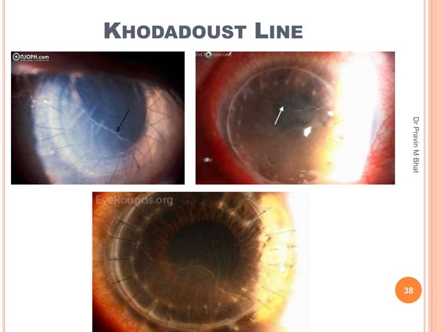 Dots spots lines and rings in ophthalmology | PPTX | Eye and Vision ...