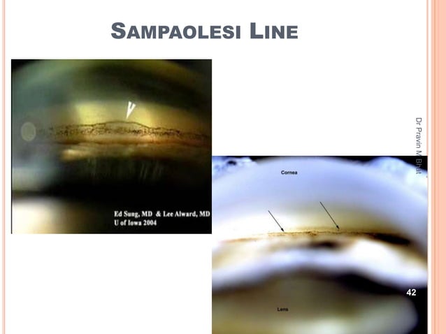 Dots spots lines and rings in ophthalmology | PPTX | Eye and Vision ...