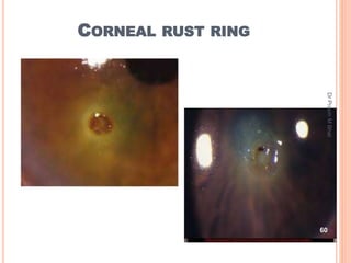 Dots spots lines and rings in ophthalmology | PPTX