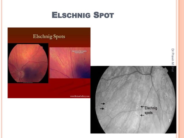 Dots spots lines and rings in ophthalmology | PPTX | Eye and Vision ...