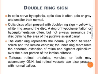 Dots spots lines and rings in ophthalmology | PPTX