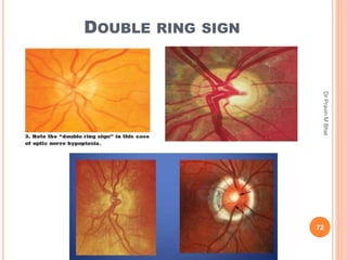 Dots spots lines and rings in ophthalmology | PPTX