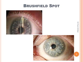 Brushfield Spots